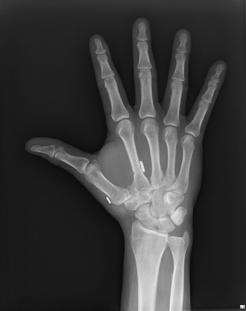 Artrosis de la base del pulgar o Rizartrosis – Doctor Matias Sala